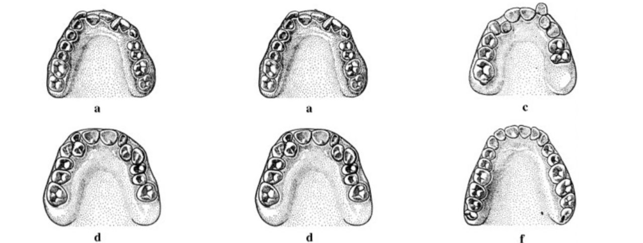 What Is Hyperdontia (Extra Teeth)? - Nu Smile Dental Center
