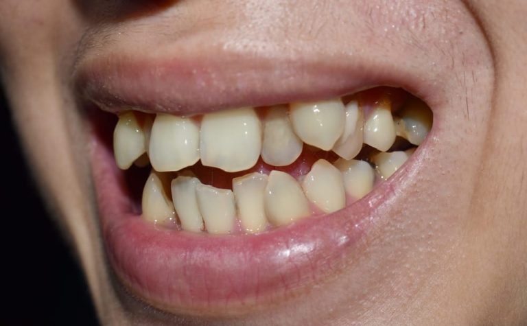 What Is Hyperdontia (Extra Teeth)? - Nu Smile Dental Center
