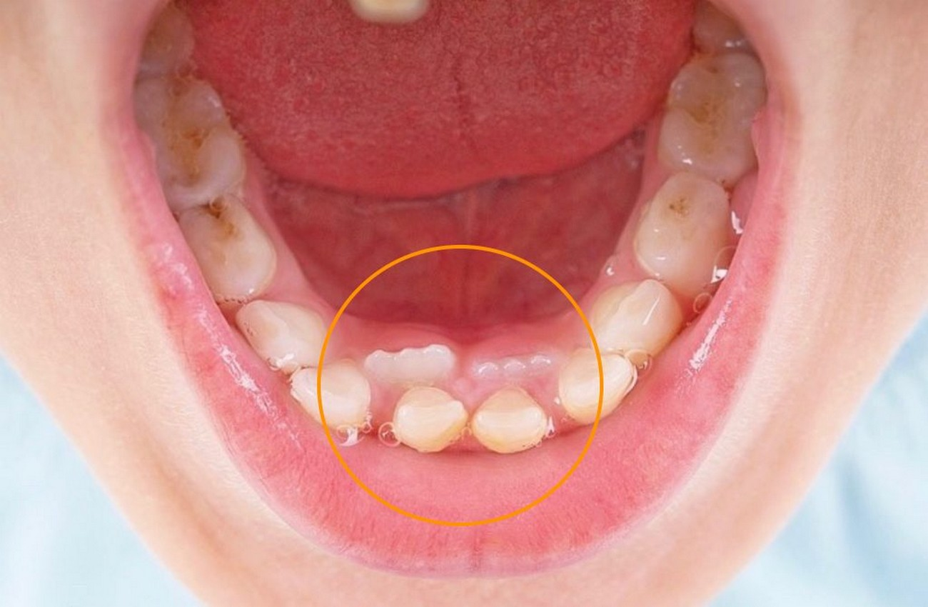 What Is Hyperdontia (Extra Teeth)? - Nu Smile Dental Center