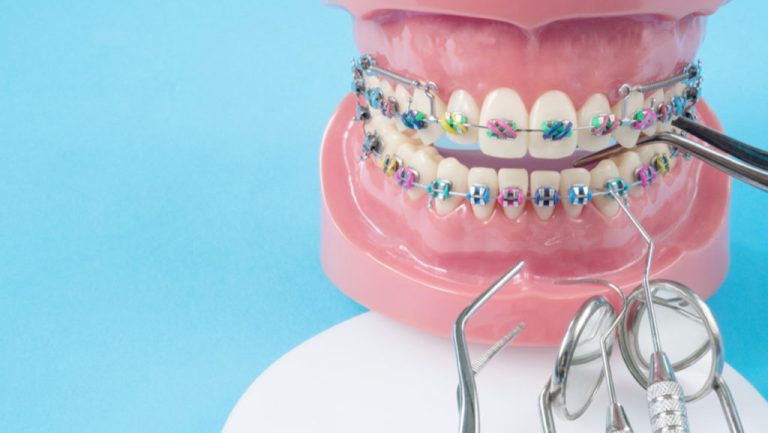 Comprehensive Guide to Orthodontic Braces Care: A Complete Resource for ...